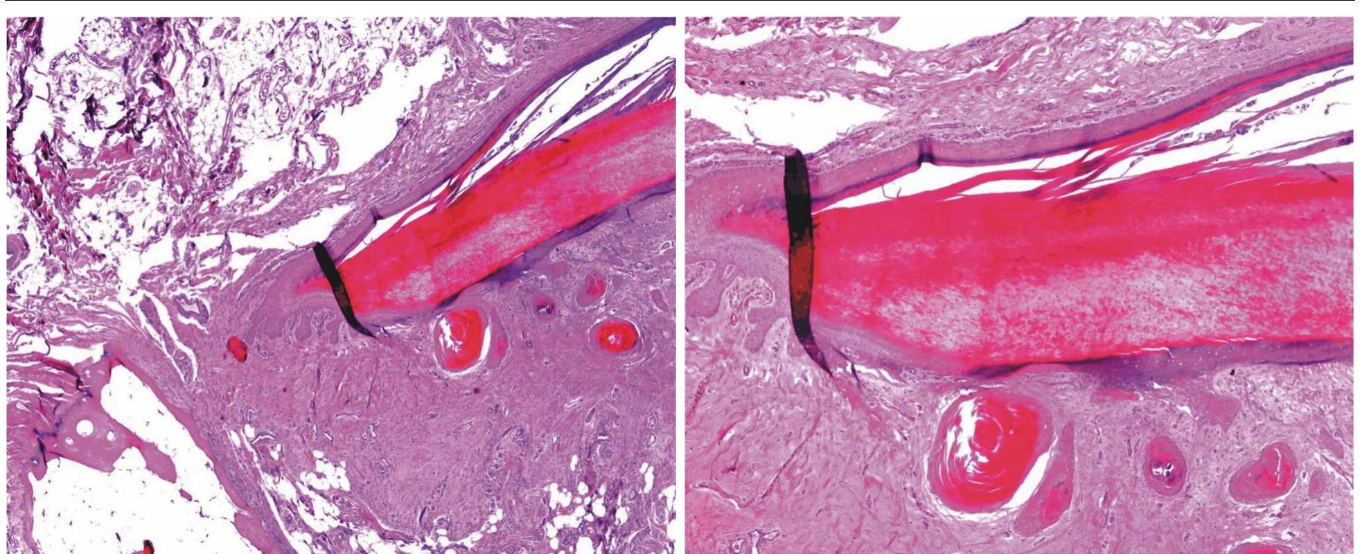 benign epithelial inclusions mimicking nests of