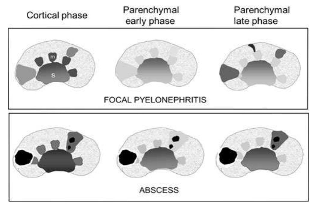 Focal pyelonephritis and abscess are shown in the different