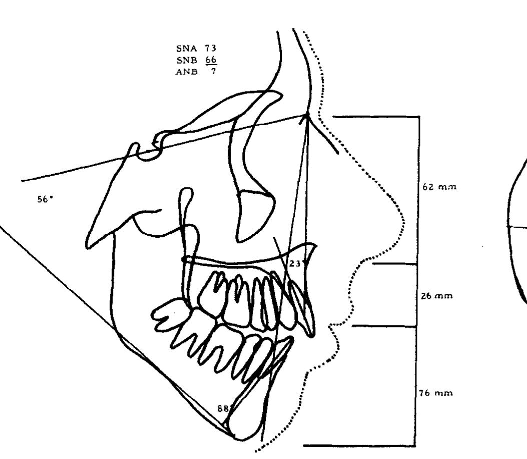 B. the “classic” cephalometric analysis demon- strates small