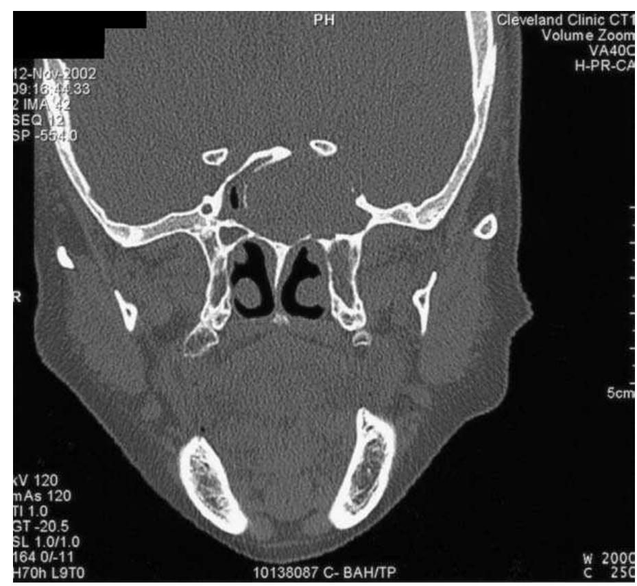 Mucocele of left sphenoid sinus (coronal ct scan).
