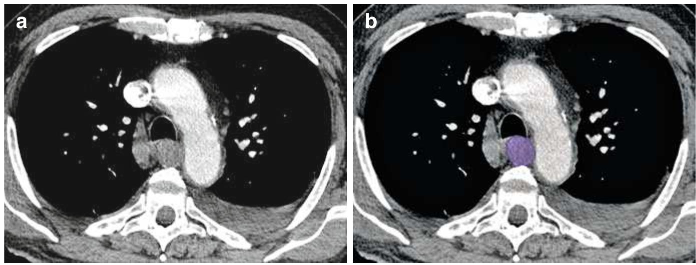 Figure 48 - Atlas of Lymph Node Anatomy
