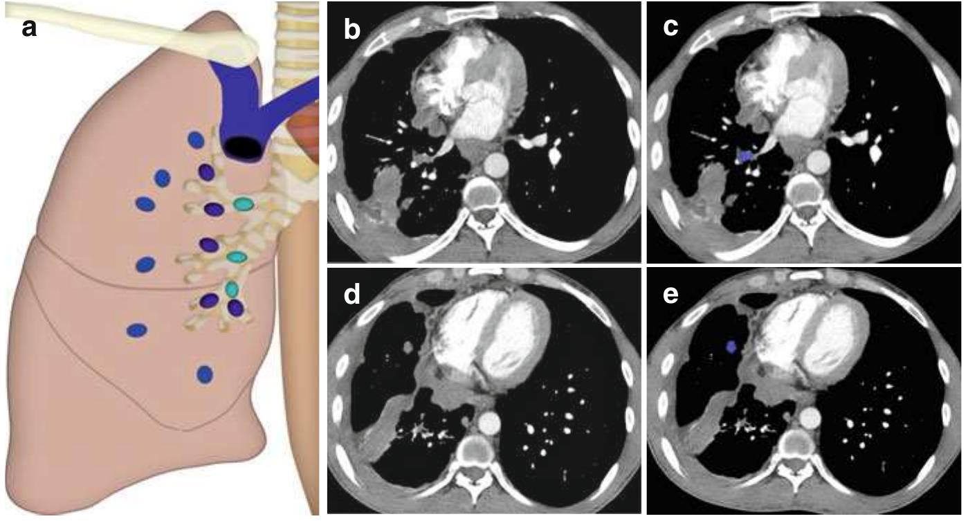 (PDF) Atlas of Lymph Node Anatomy