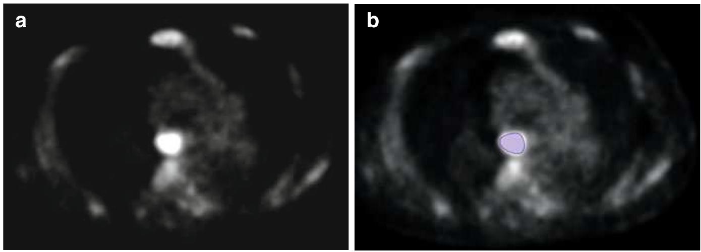 31 (a, b) axial pet scan of the thorax shows fdg avid uptake