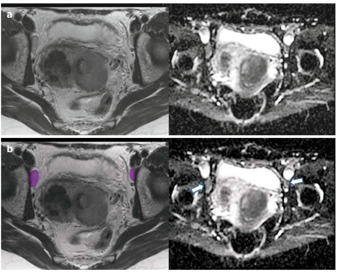 24 (a, b) axial t2-weighted (left image) and adc images
