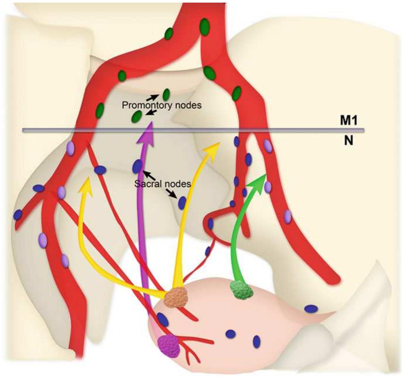 55 schematic shows common routes of metastasis from bladder