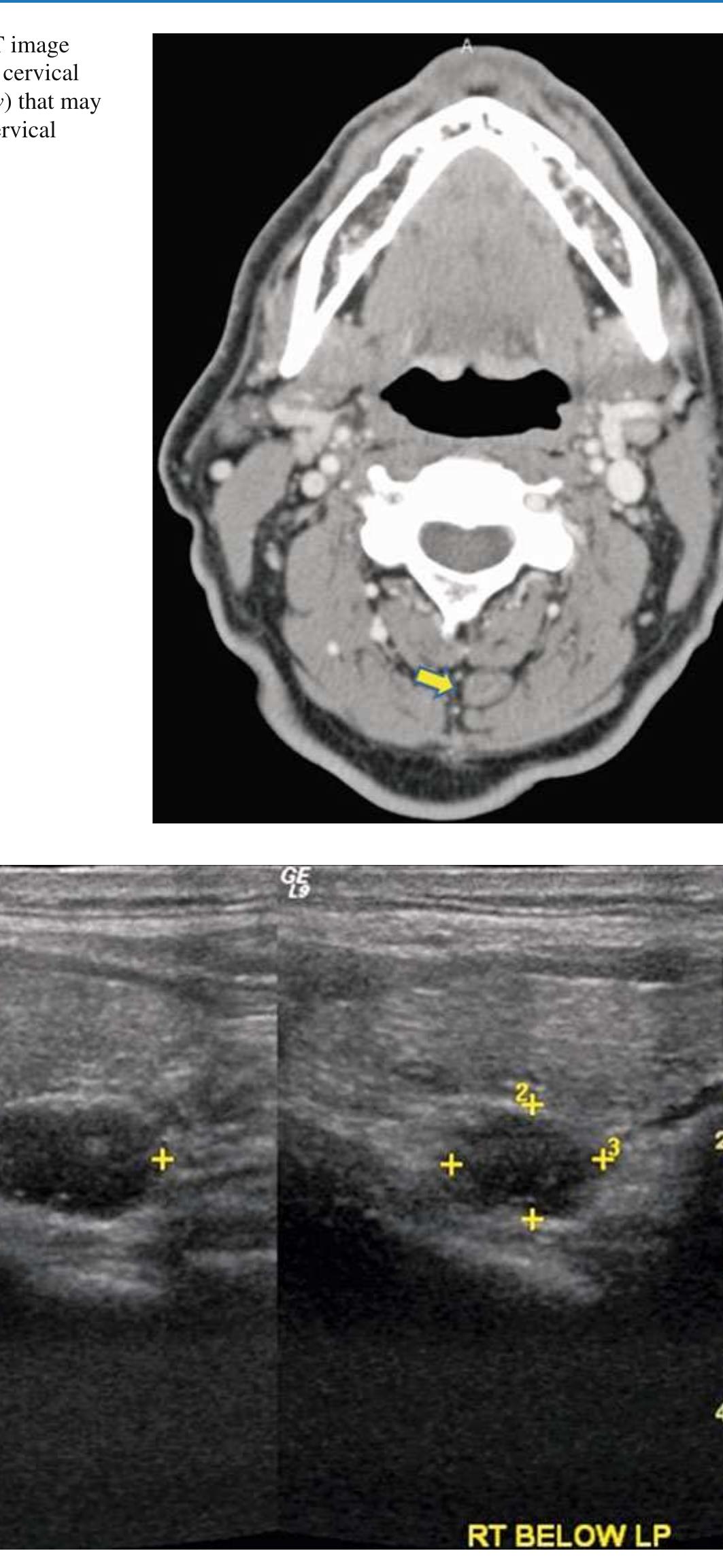 12 ultrasound image of the neck shows a hypoechoic lesion