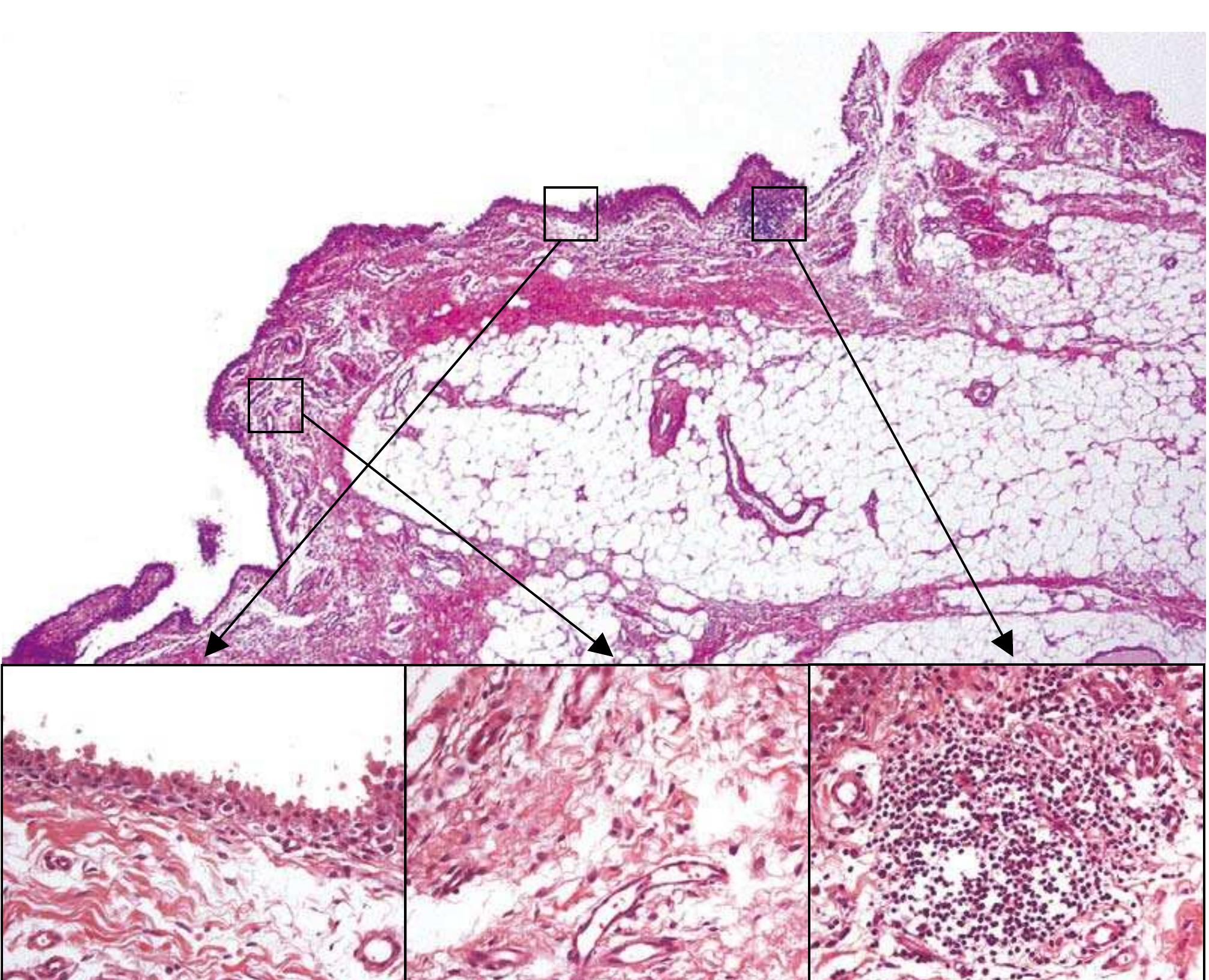 Post-traumatic arthritis. the synovial lining cell layer is