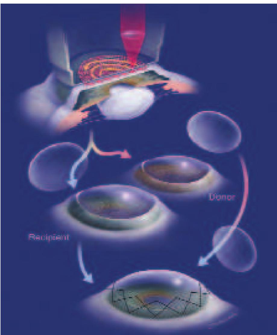 Schematic of anterior corneal trans- plant procedure: the