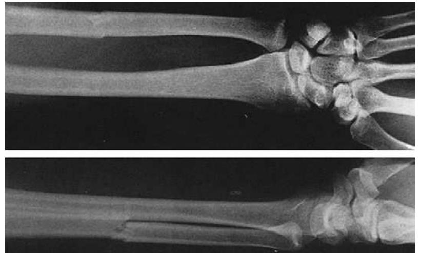 The nightstick fracture is an isolated fracture of the