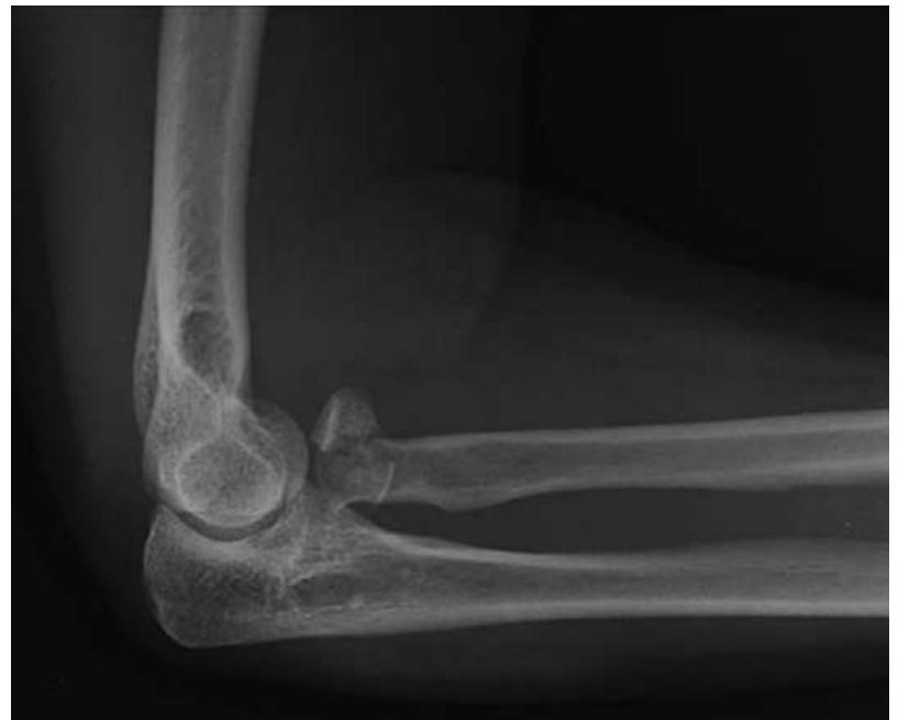 Radial head fracture (mason type ii). (courtesy of e. labat,