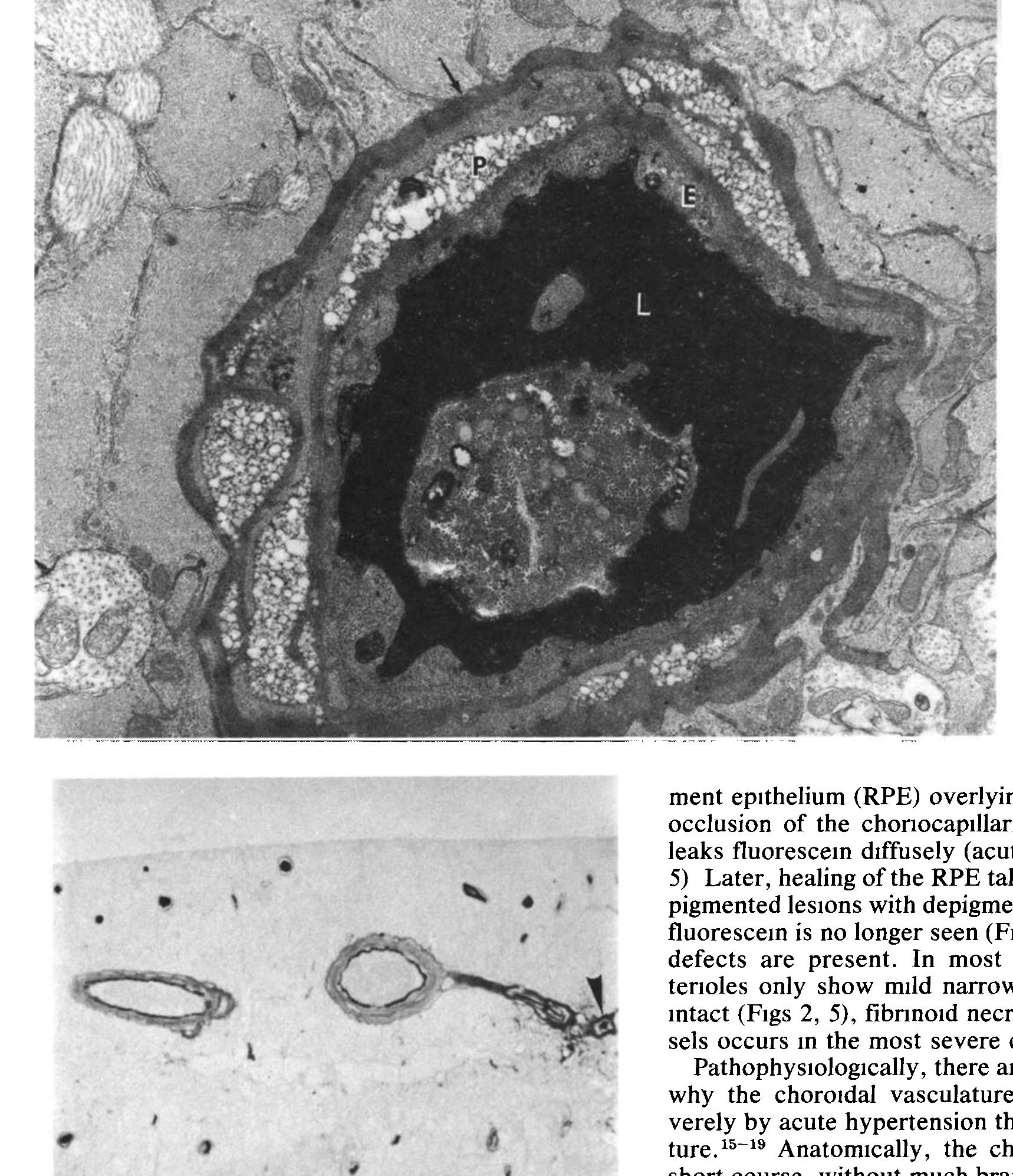 Figure 11 - from Pathophysiology of Hypertensive Retinopathy