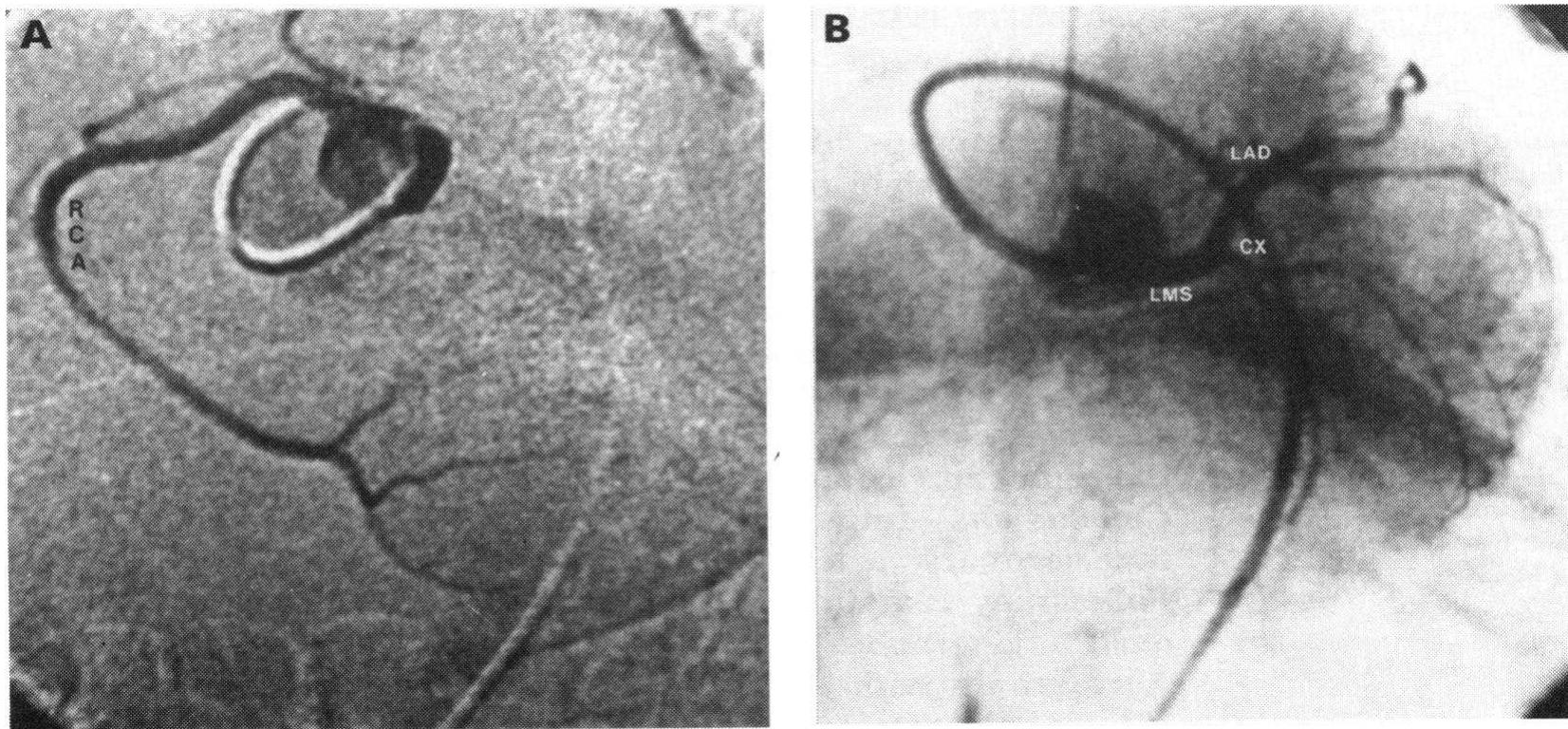 Selective right (a) and left (b) coronary artery injections