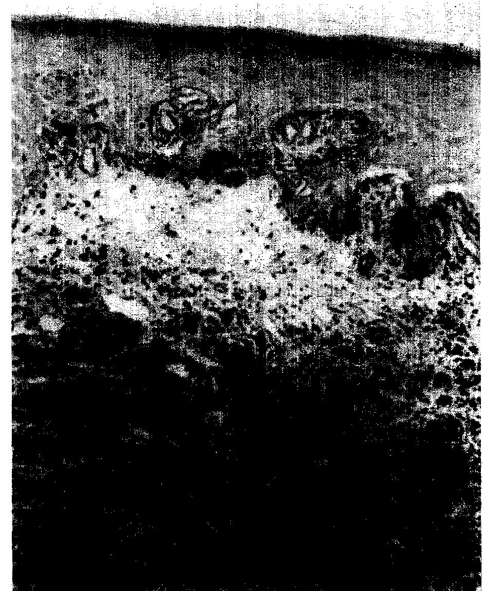 Pas stain of buccal mucosal lupus erythemato- sus. the