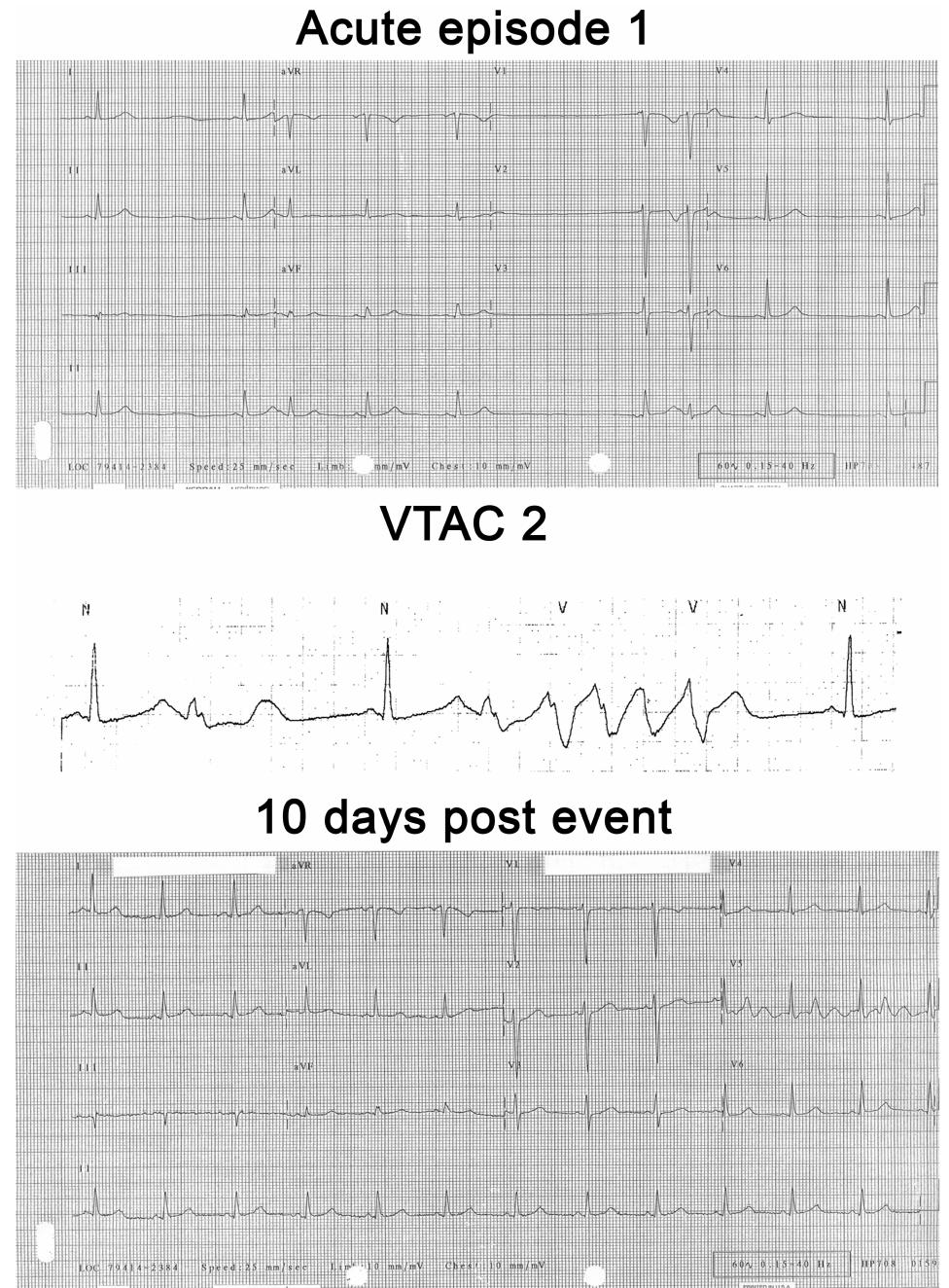 The electrocardiogram (ecg) tracing of the patient’s first