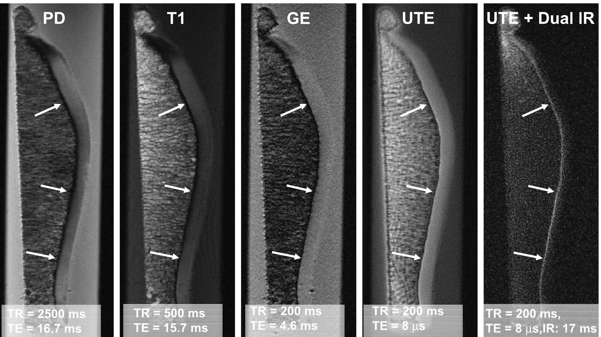 Axial mr images of cadaveric patellar specimen.
