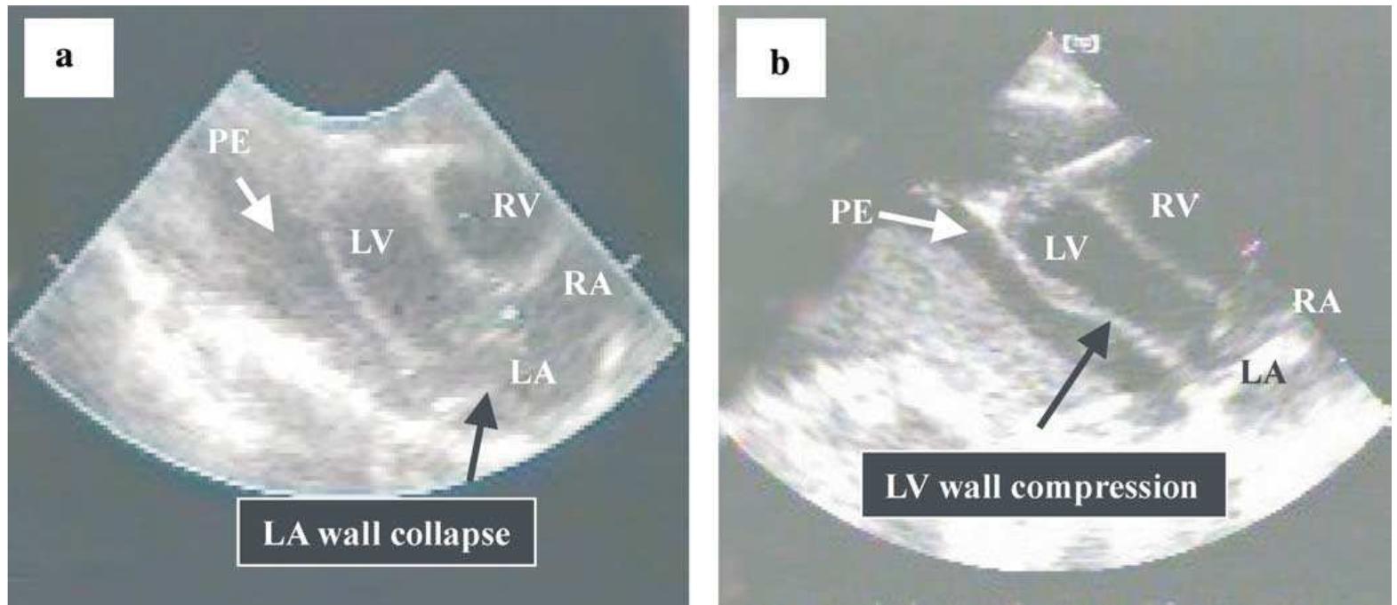Two-dimensional echocardiagraphic images of heart from