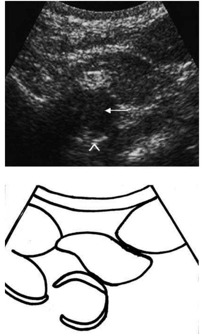 Sonographic appearance and accompanying diagram of the fluid