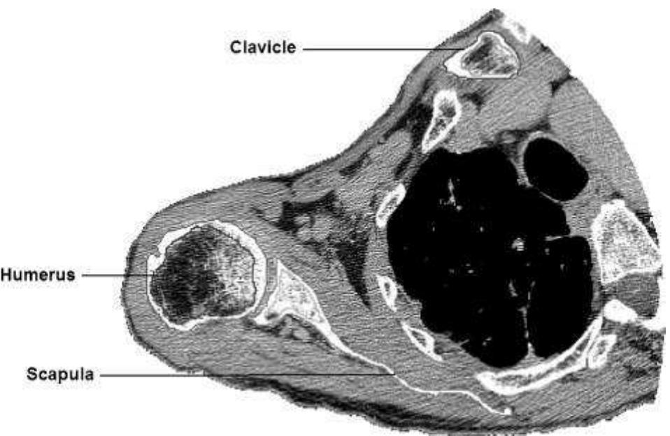 Ct scans of the shoulder: bone contour detection. note: both