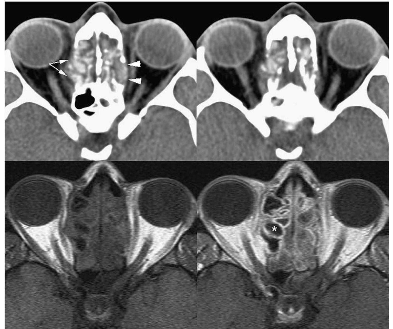 (a—d) eosinophilic fungal rhinosinusitis. axial ct (a and