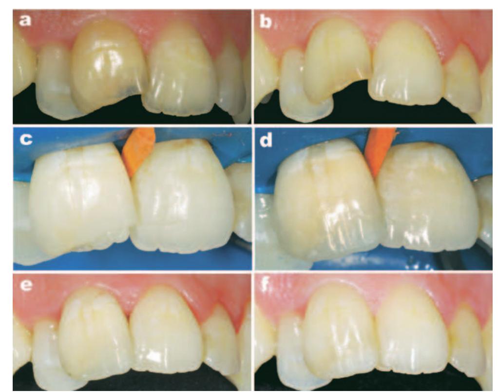 Figure 1 - Nonvital Tooth Bleaching: A Review of the