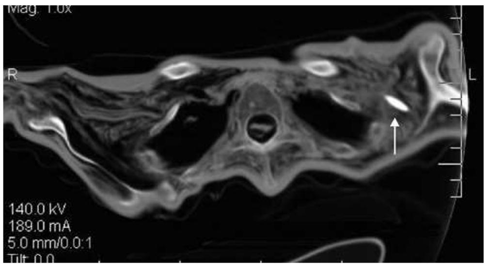 Ct-scan of thorax showing the foreign body in the soft