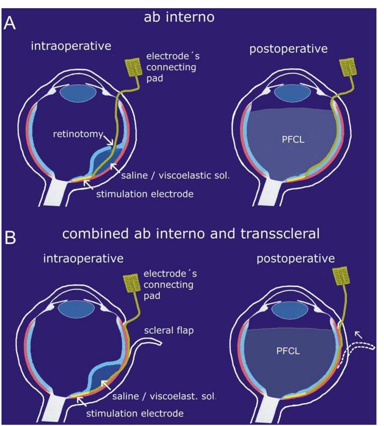 Schematic diagrams illustrating (a) ab interno implantation