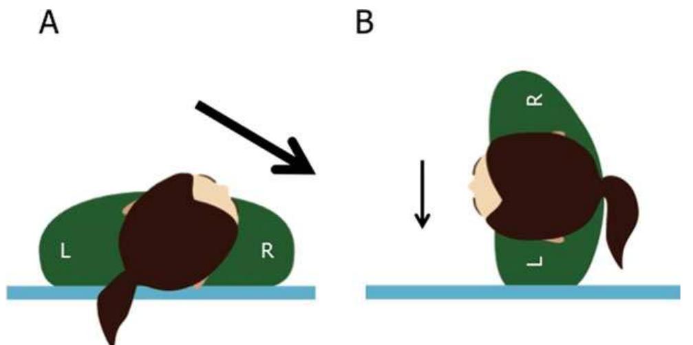 Geotropic nystagmus after canalith repositioning proce-
