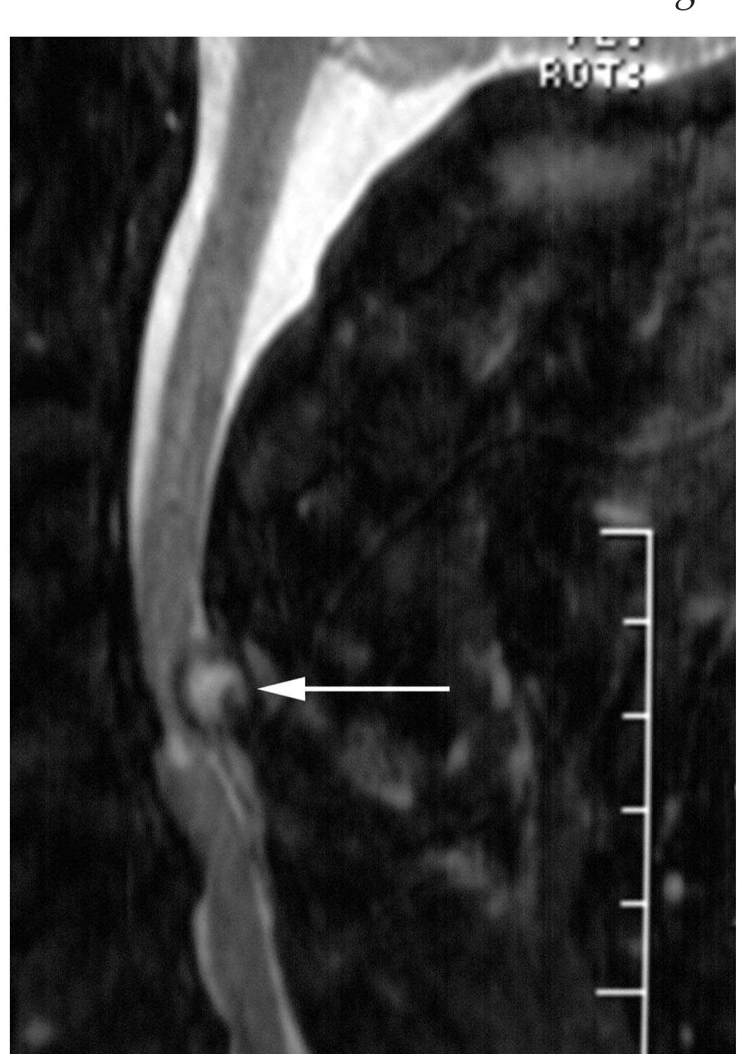T2-weighted sagittal mri of the cervical spine, showing a
