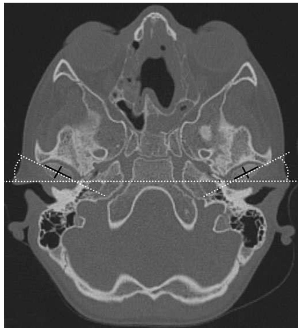 Results fig. 1 transverse computed tomography imaging plane