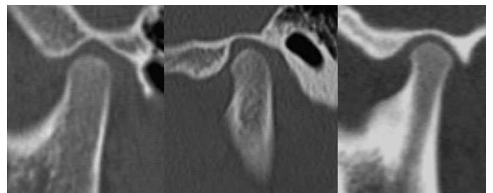 , reformatted sagittal computed tomography images demon-