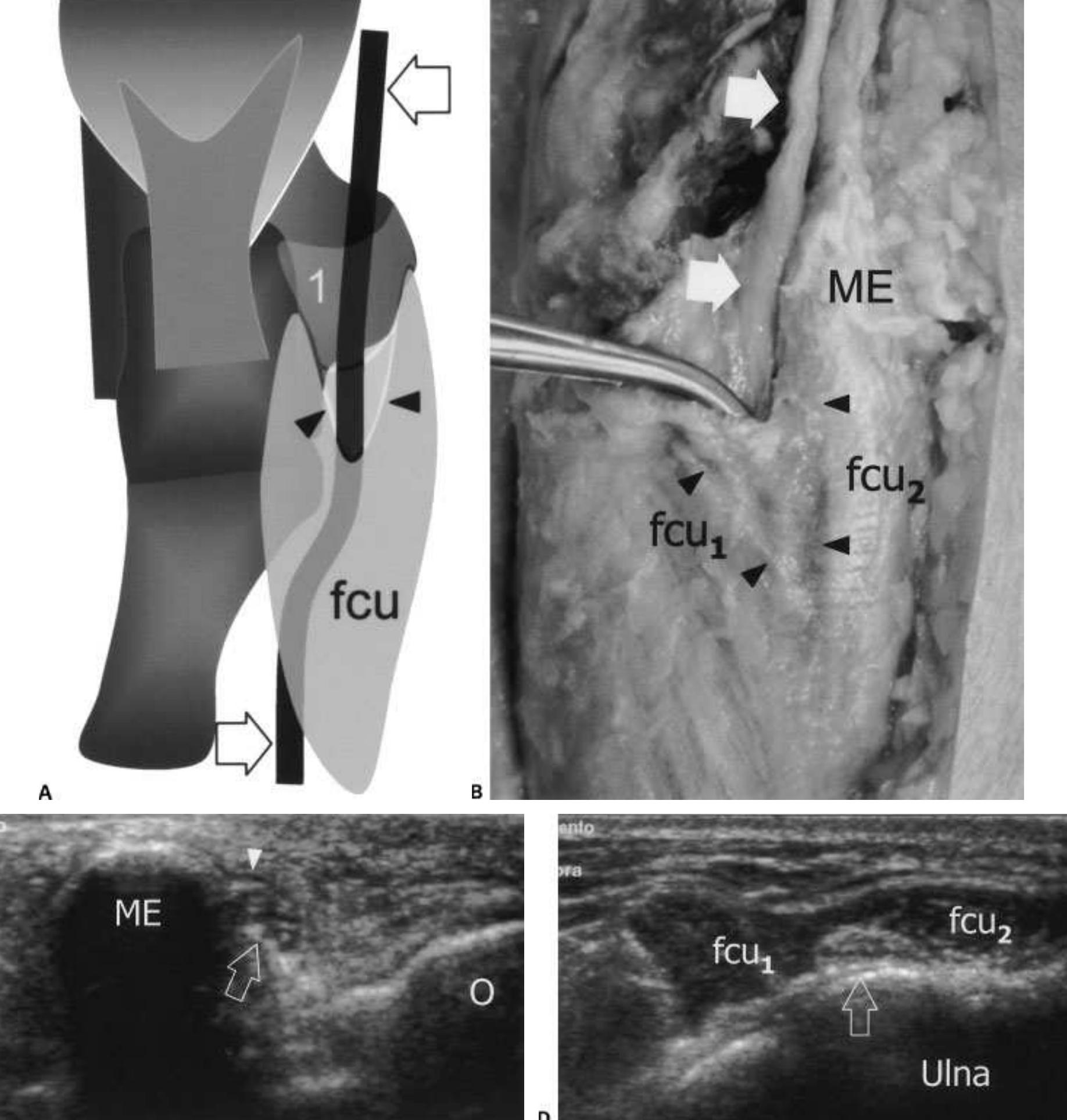 Figure 13 - from Sonography of entrapment neuropathies in