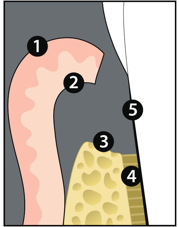 Periodontal wound following flap surgery: (1) gingival