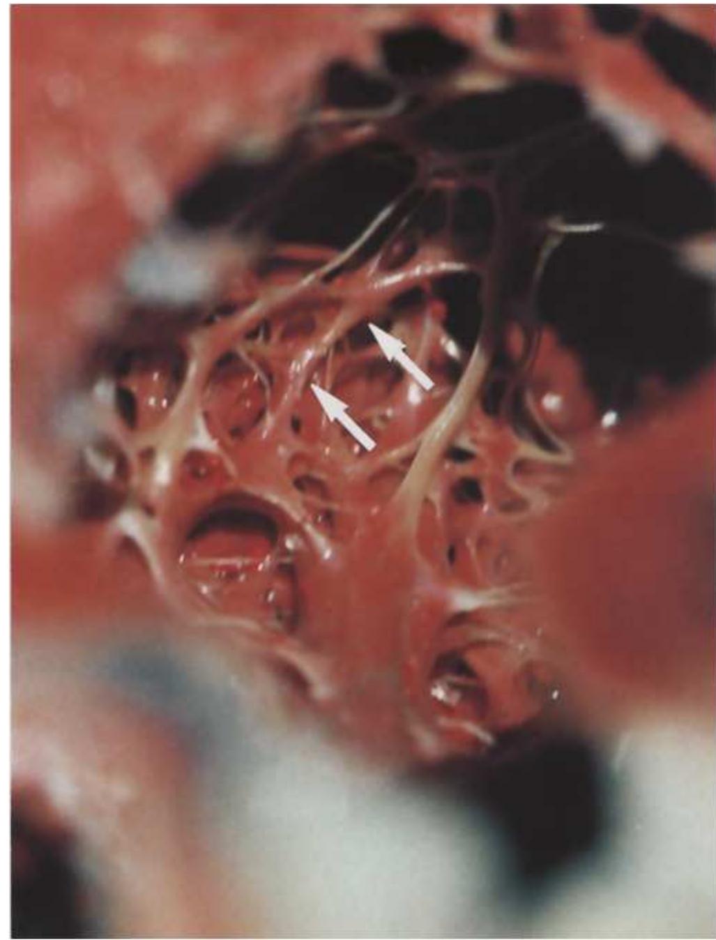 Intraoperative view of left ventricular trabeculae of a