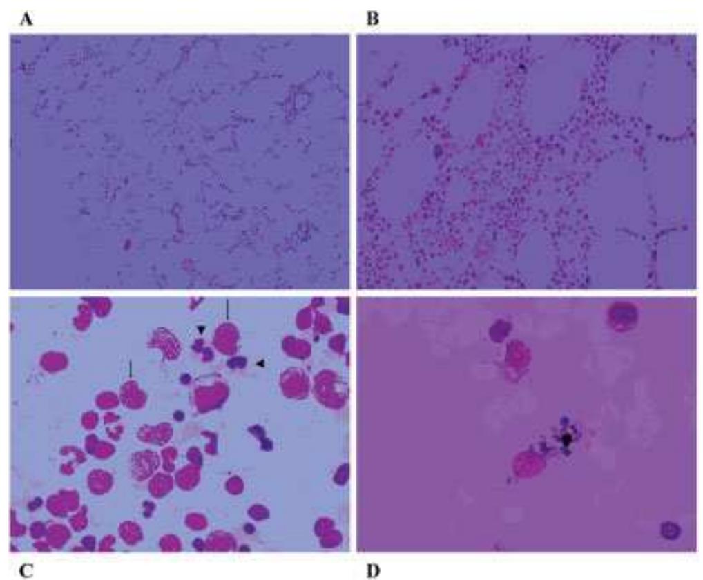 Bone marrow biopsy and aspirate smear. a, bone marrow core