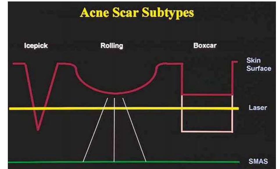 Novel classification system of 3 basic scar types: icepick,