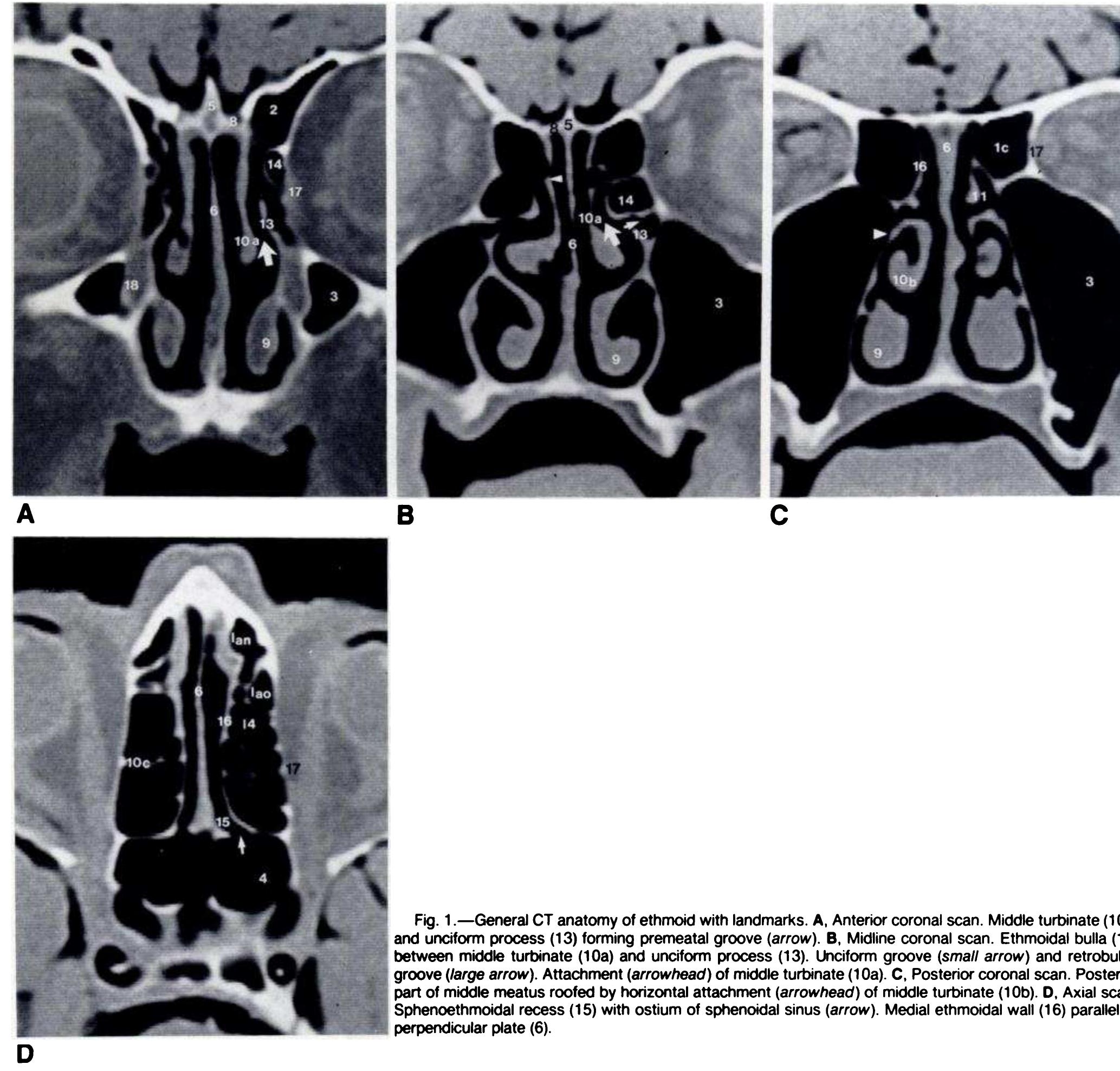 (PDF) Anatomy of the ethmoid: CT, endoscopic, and macroscopic