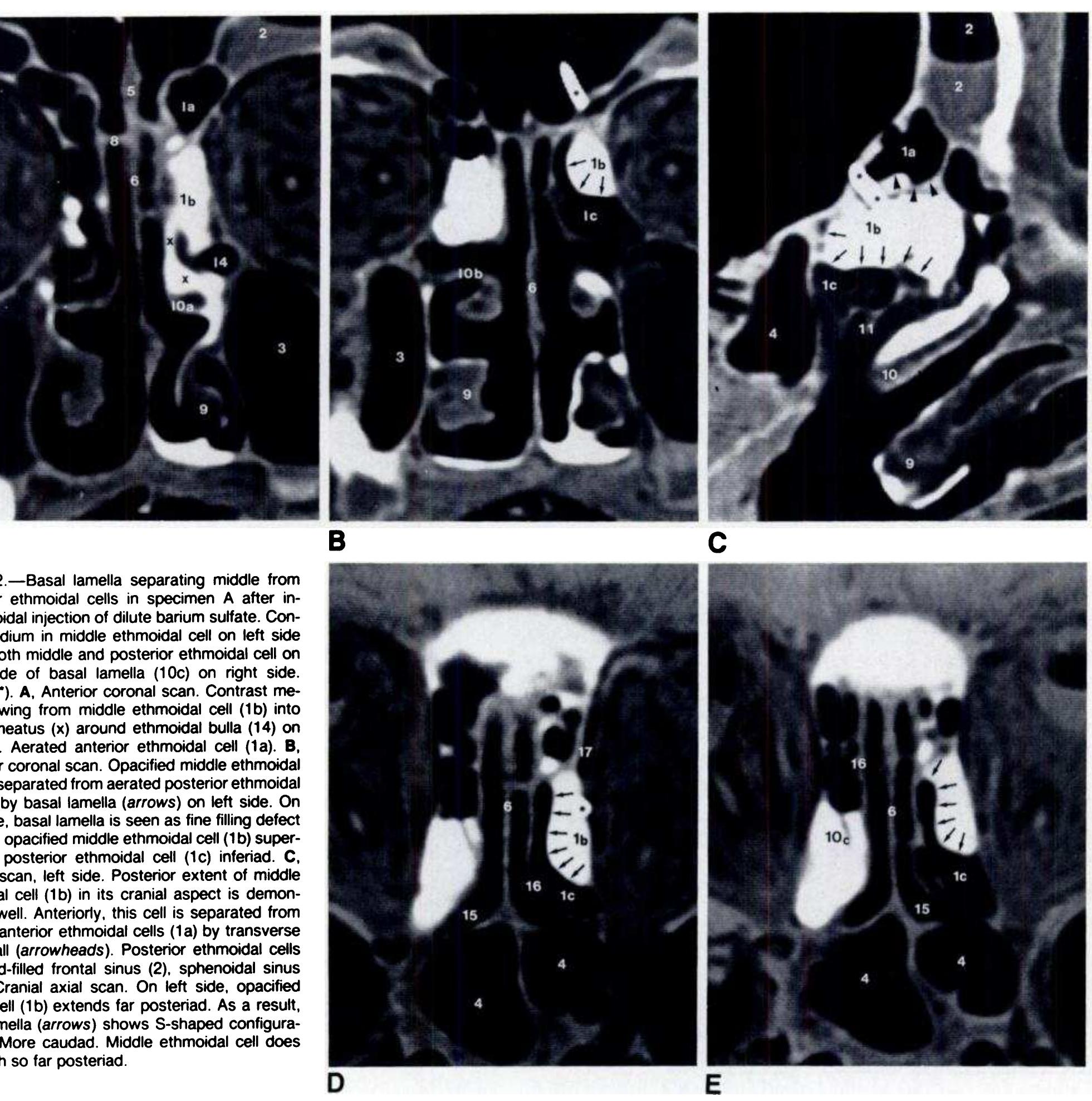(PDF) Anatomy of the ethmoid: CT, endoscopic, and macroscopic