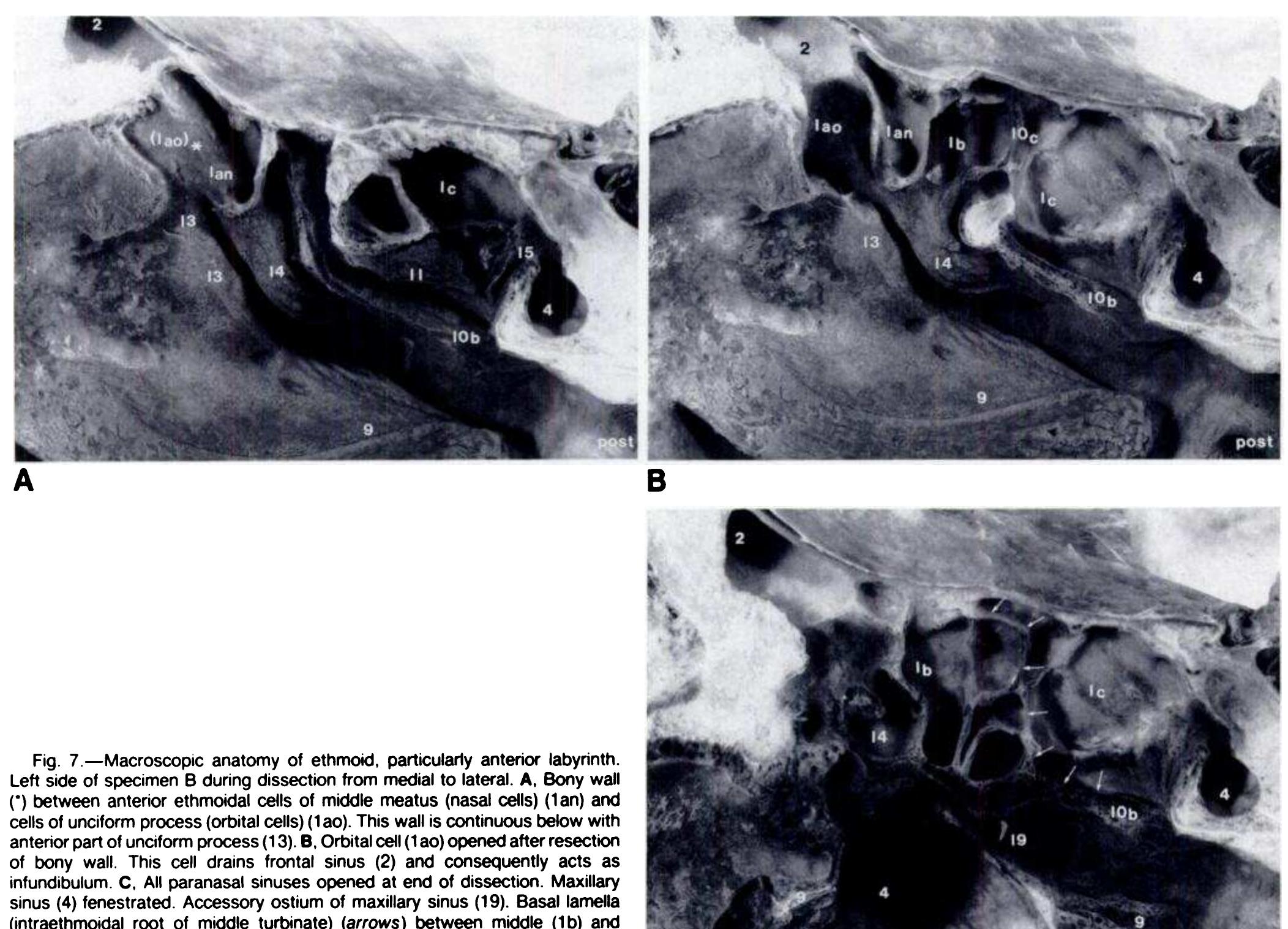 Figure 6 - from Anatomy of the ethmoid: CT, endoscopic, and