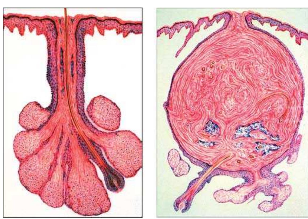 Normal sebaceous follicle (left) and comedo (right). from