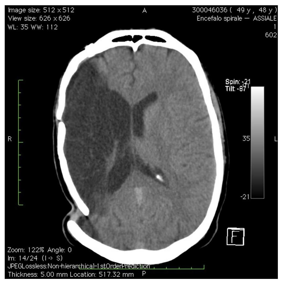 Preoperative axial ct showing detachment and sinking of a