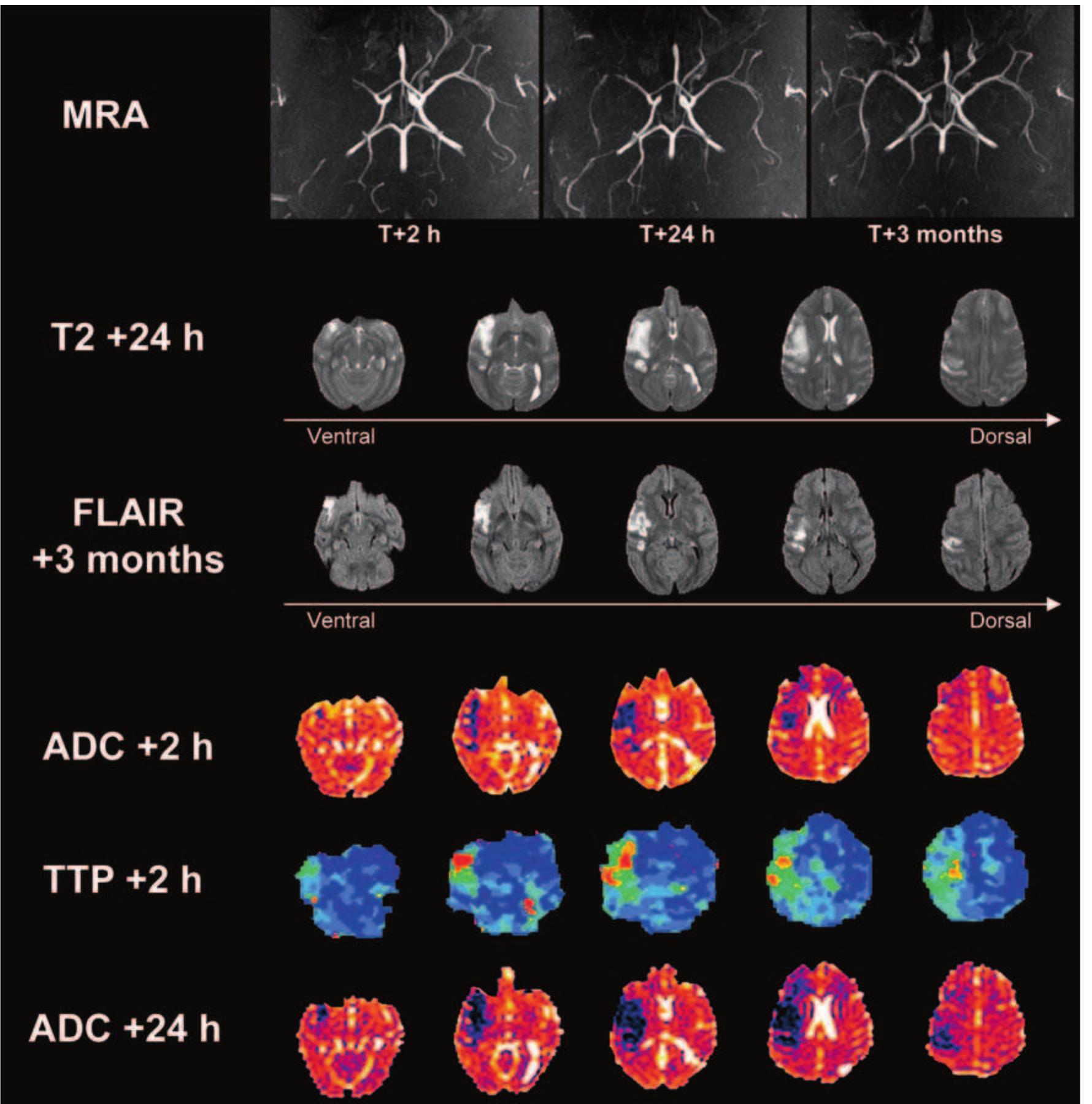 Complete occlusion of the proximal section of the mca
