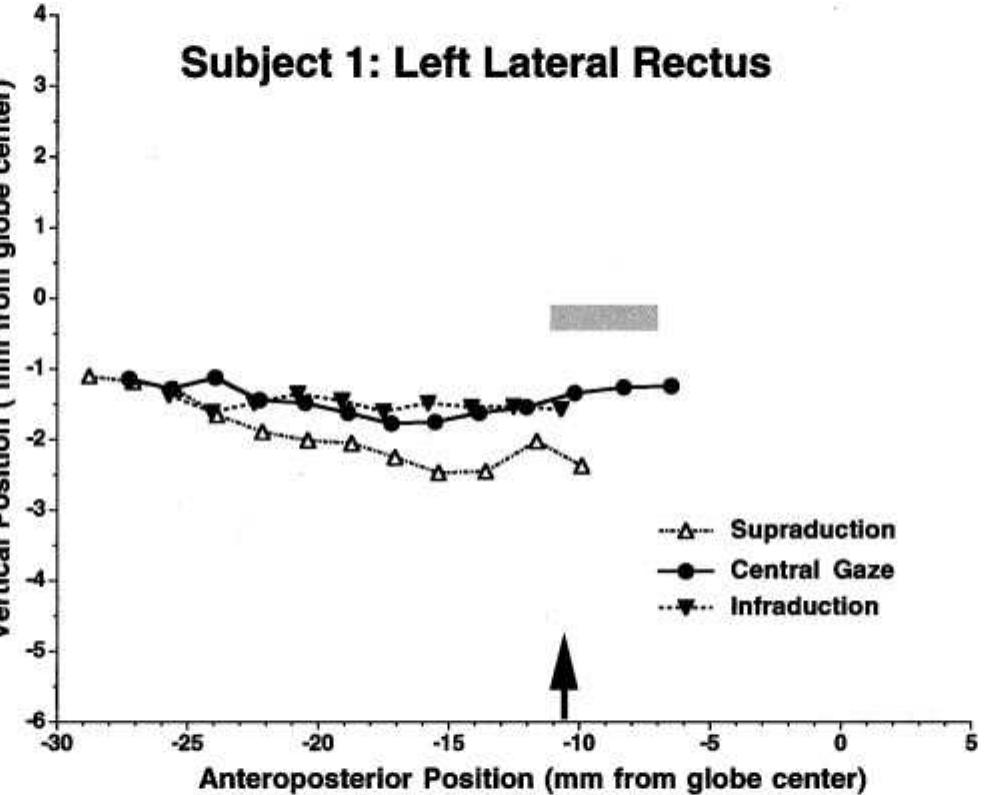Subject 1: vertical area centroid positions of the left lr
