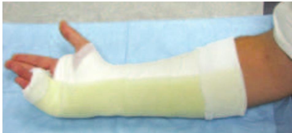 Ulnar gutter splint with underlying stockinette and