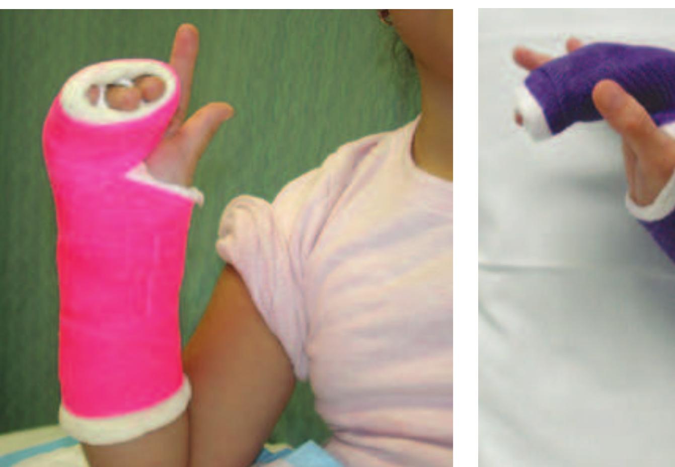 Radial gutter cast. figure 3. ulnar gutter cast.