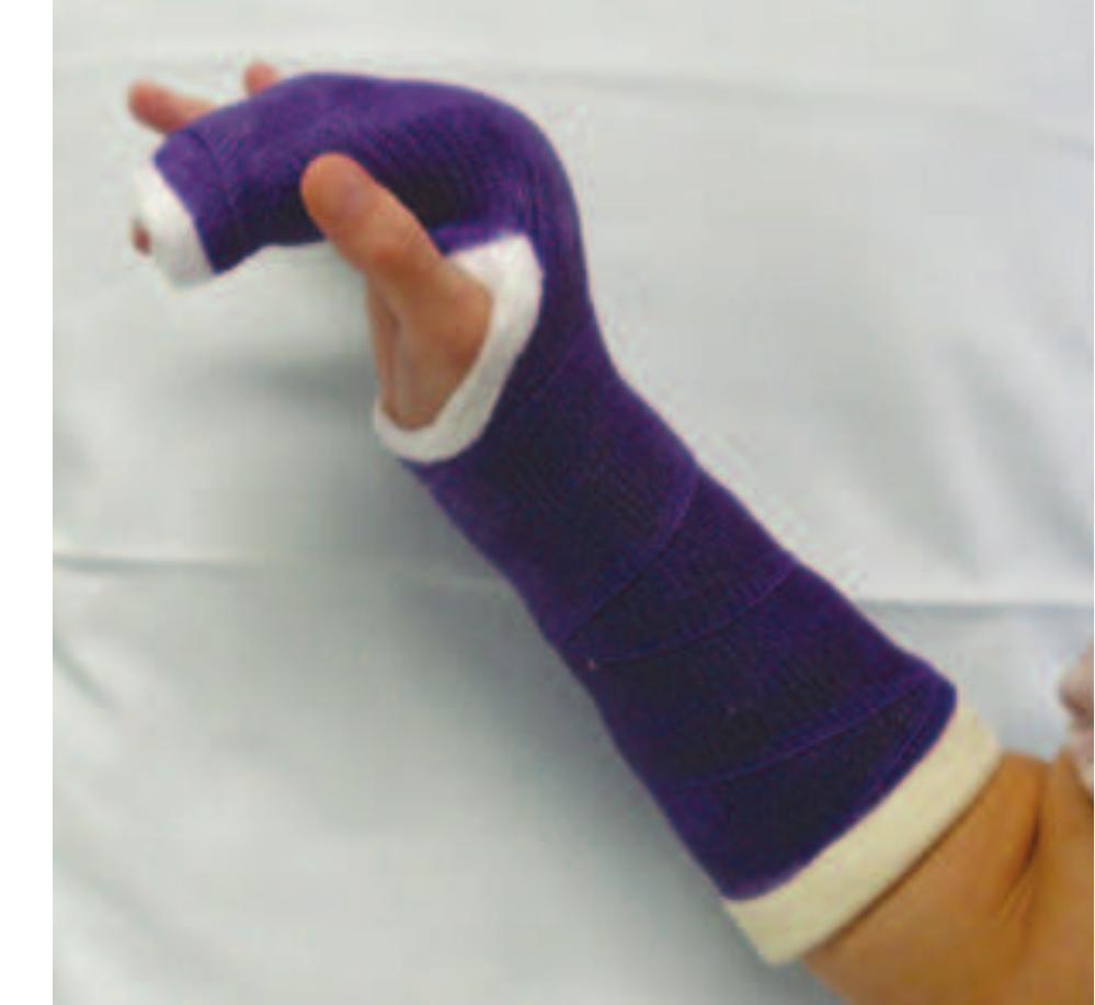 Figure 4 - Splints and casts: indications and methods