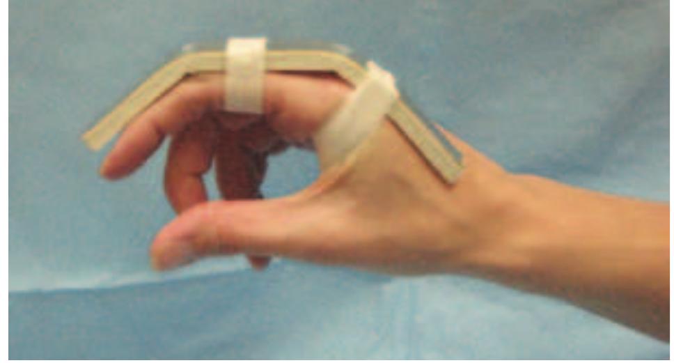 Dorsal extension-block splint. figure 5. thumb spica cast.