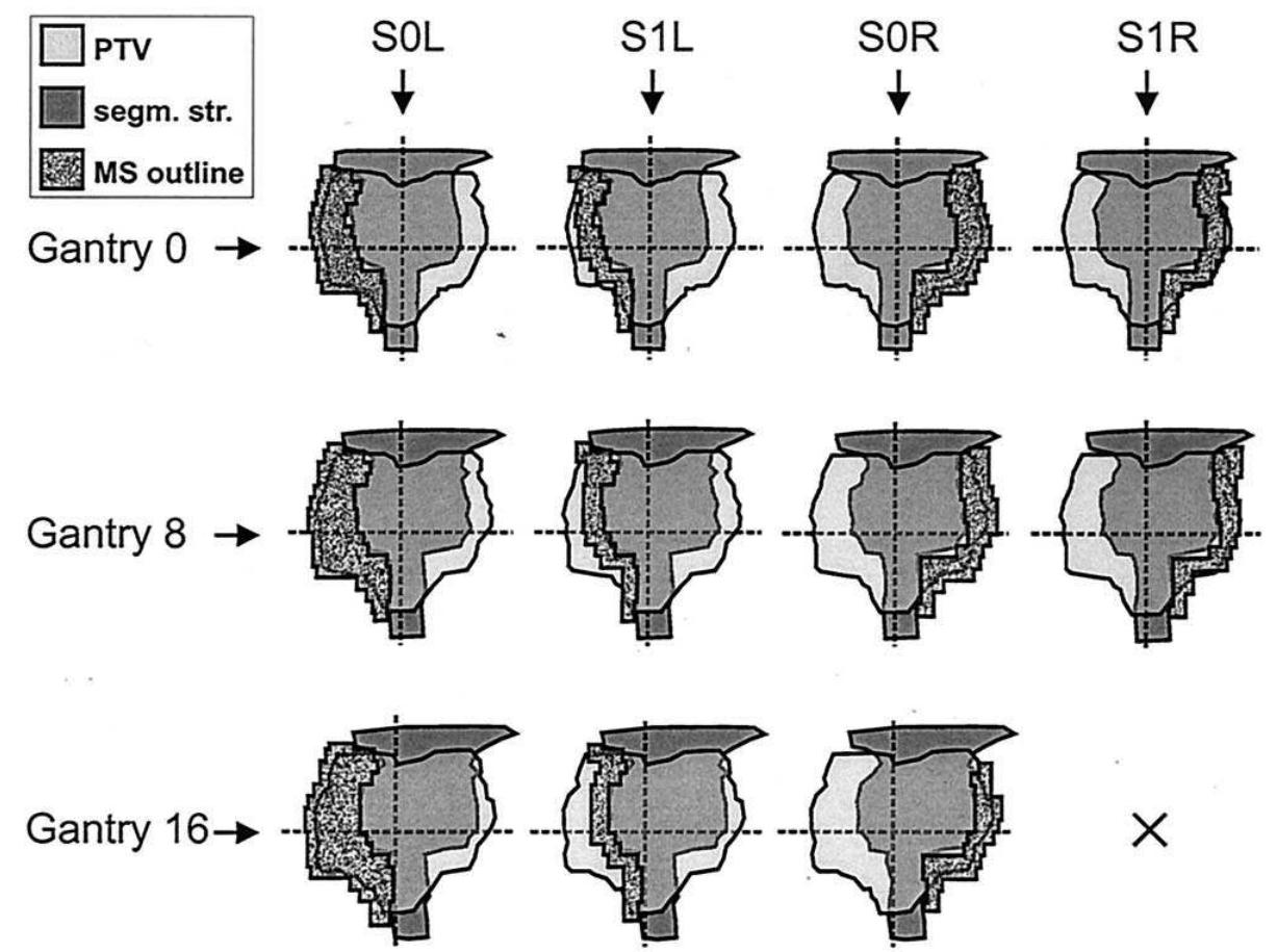 Anatomy-based are generation shown in beam’s-eye view (bev).