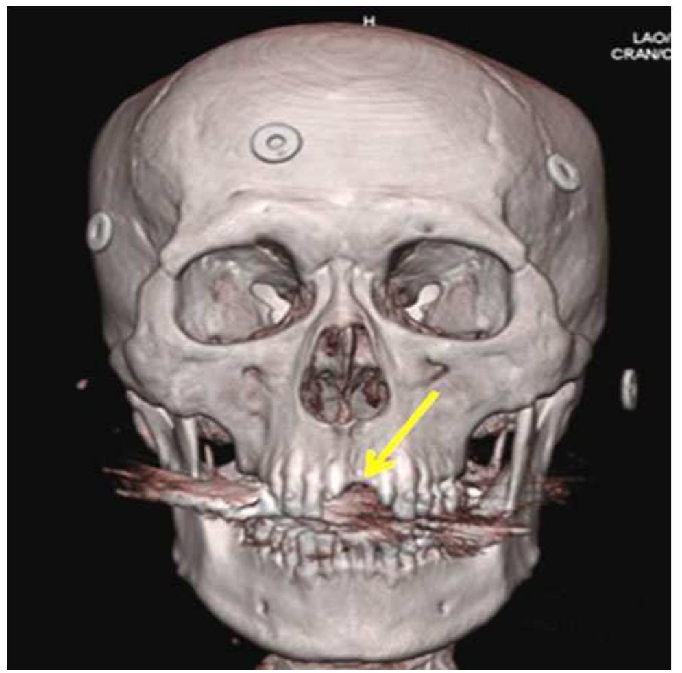 Ct, 3d reconstruction of the skull showing the destruction