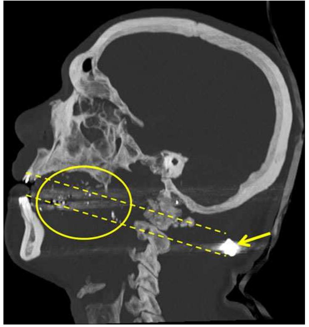 Ct, 2d sagittal reconstruction displaying bone and bullet