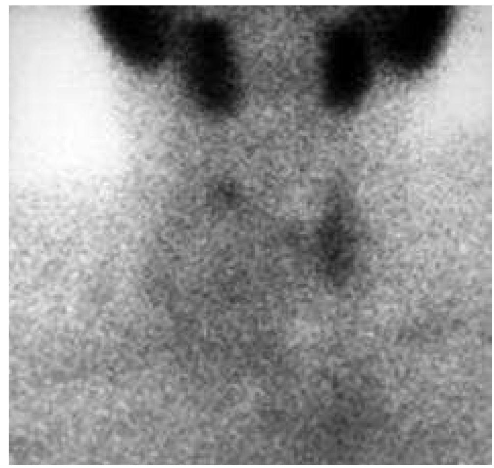 tc thyroid scan shows a cold nodule in the right lobe.